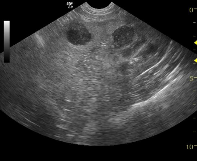 Splenic lymphoid hyperplasia, extramedullary hematopoeisis, and a ...