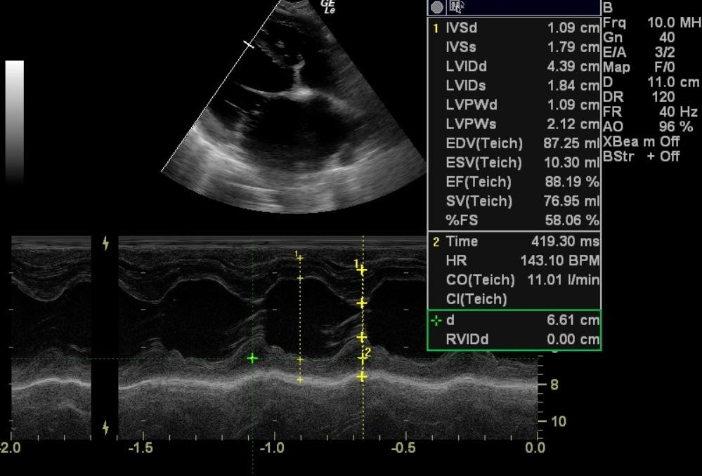 Endocarditis, Ruptured Chordae, Mitral prolapse, and Aortic Aneurism ...