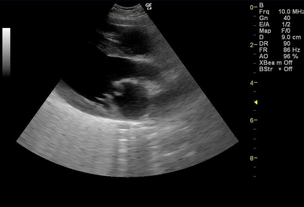 Acute Respiratory Distress Syndrome possible Pulmonary Thromboembolism ...
