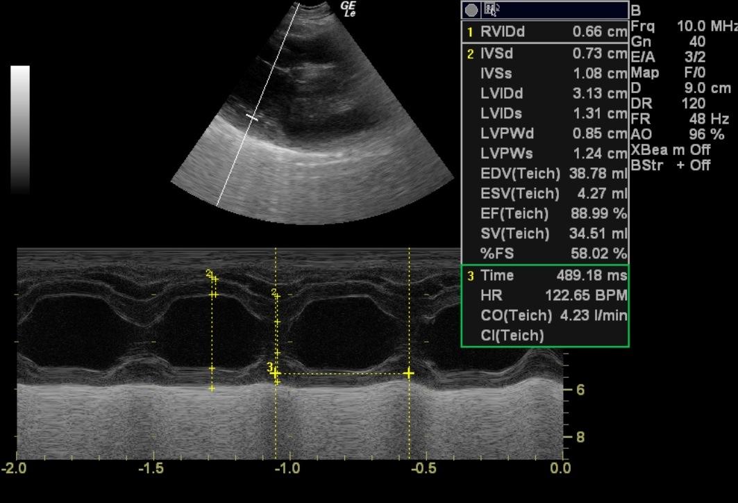 Acute Respiratory Distress Syndrome possible Pulmonary Thromboembolism ...