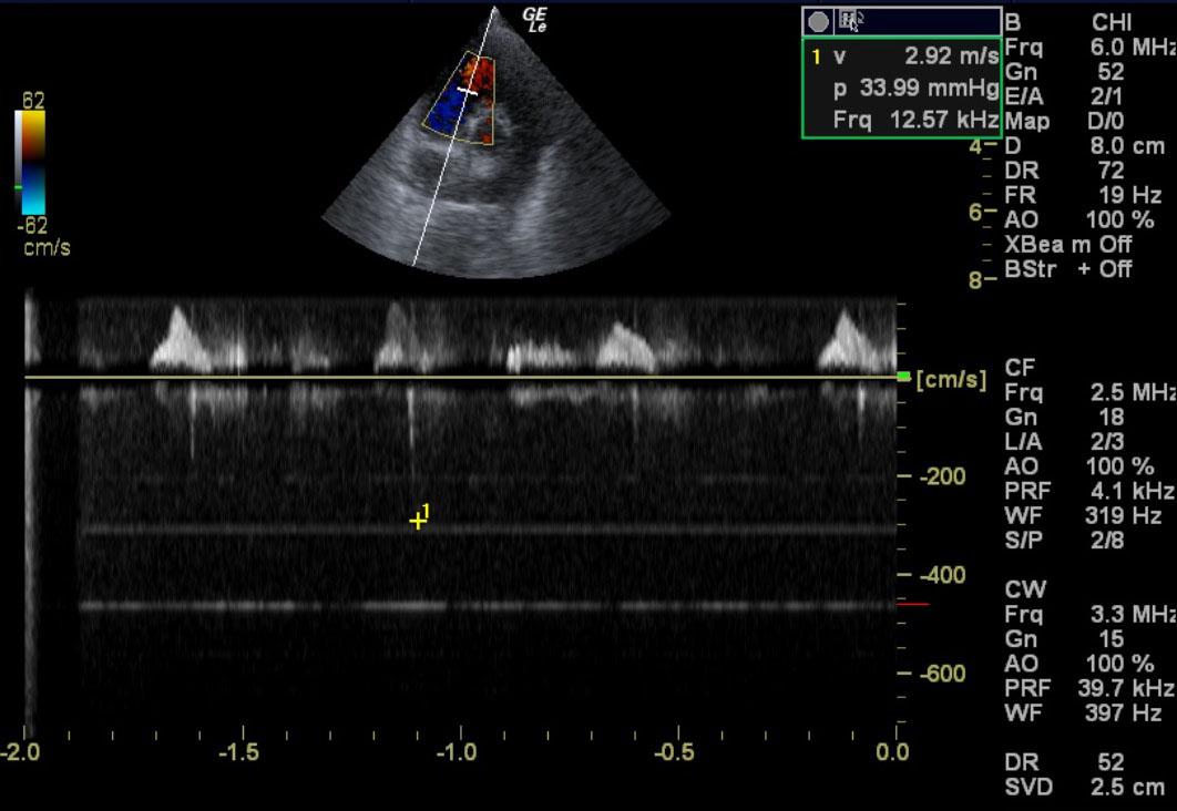 Acute Respiratory Distress Syndrome possible Pulmonary Thromboembolism ...