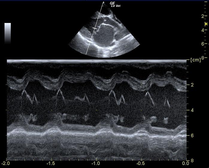 Flail mitral valve. Left and right sided congestive heart failure ...