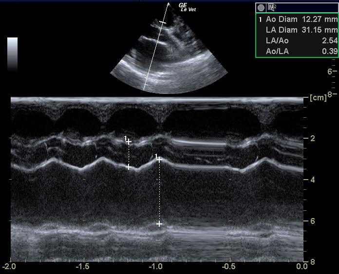Flail mitral valve. Left and right sided congestive heart failure ...