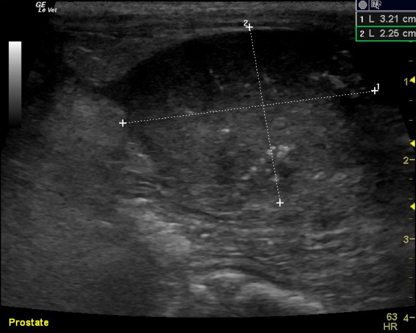 Transitional cell carcinoma of the prostate and lymph node in a 13 year ...