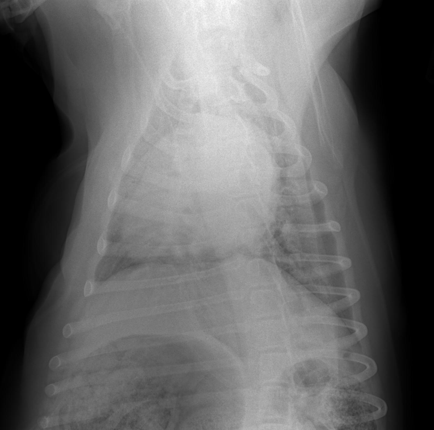 RADS - Chronic Upper Airway Obstruction with Chronic Inflammatory ...