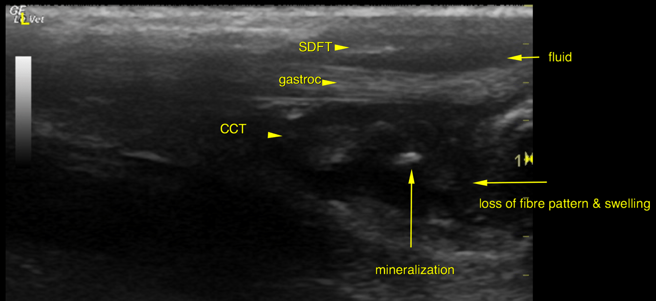 ORTHO - Partial avulsion rupture of the calcaneal tendon with ...