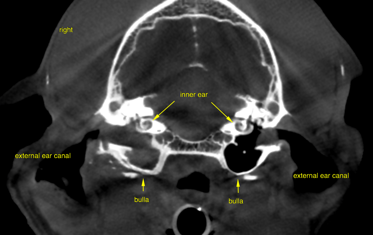 CT - Chronic otitis media with inflammation and reactive lymphadenitis ...