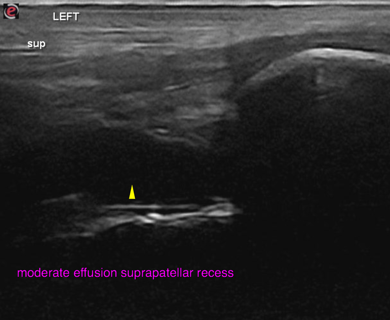 ORTHO - Chronic partial avulsion rupture of the patellar ligament, pre ...