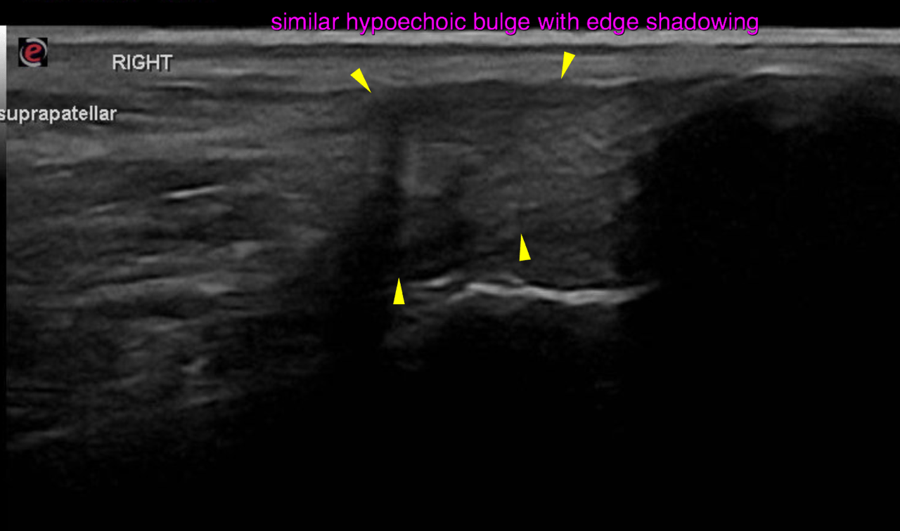ORTHO - Bilateral chronic focal tendinitis of the distal insertion ...