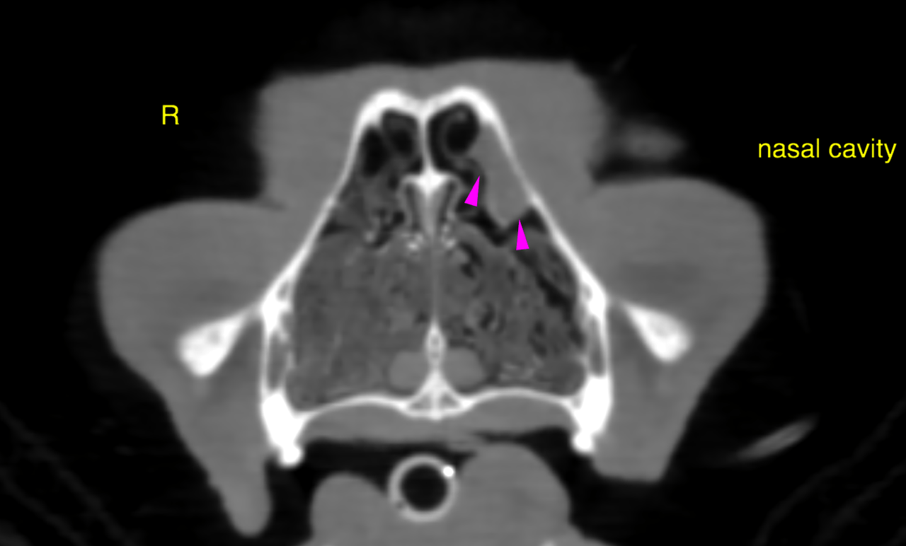 CT - Polyploid hyperplasia of the frontal sinus and nasal conceal ...
