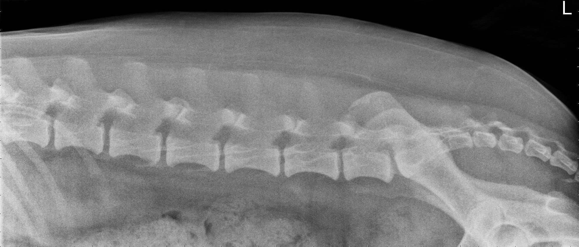 ORTHO - Bilateral chronic focal tendinitis of the distal insertion ...
