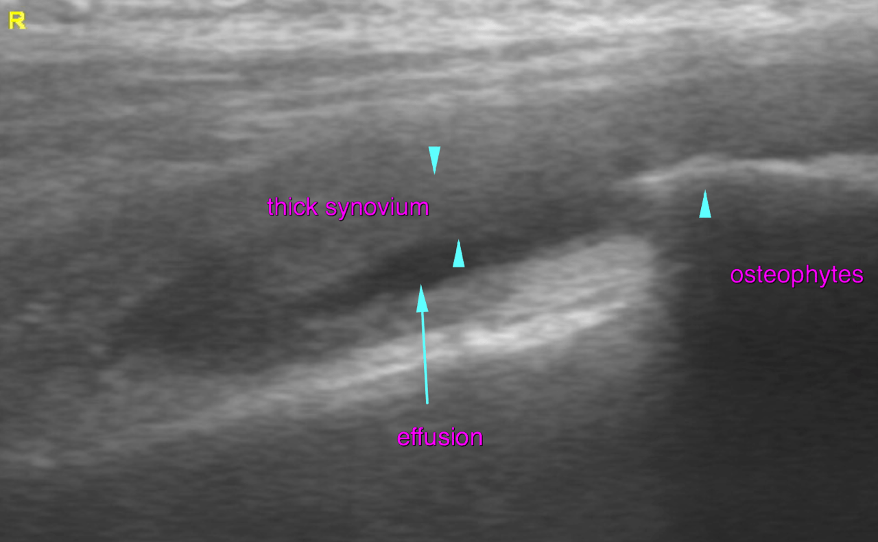 ORTHO - Full right cranial cruciate ligament (CCL) rupture in a 7 year ...