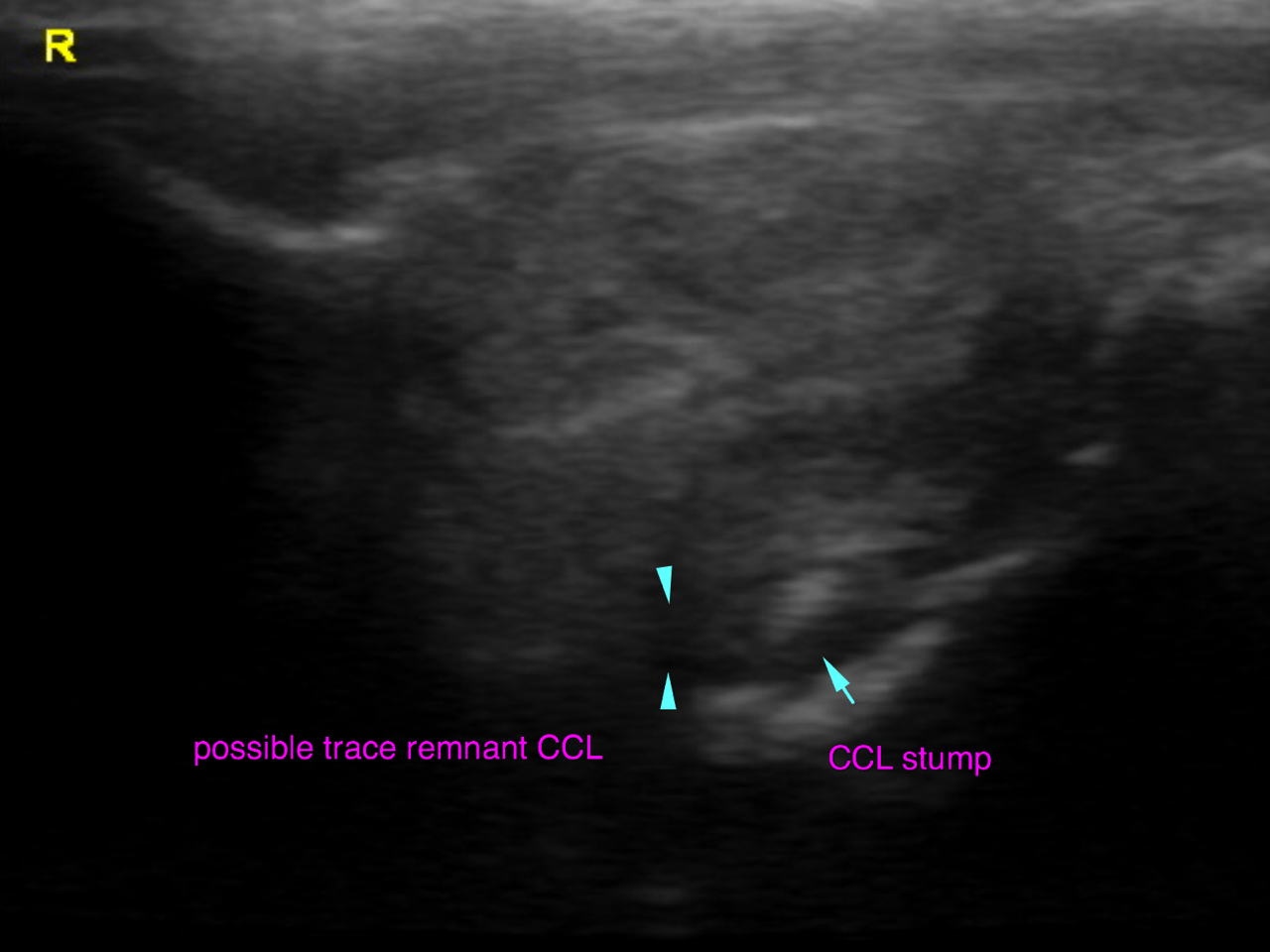 ORTHO - Full right cranial cruciate ligament (CCL) rupture in a 7 year ...