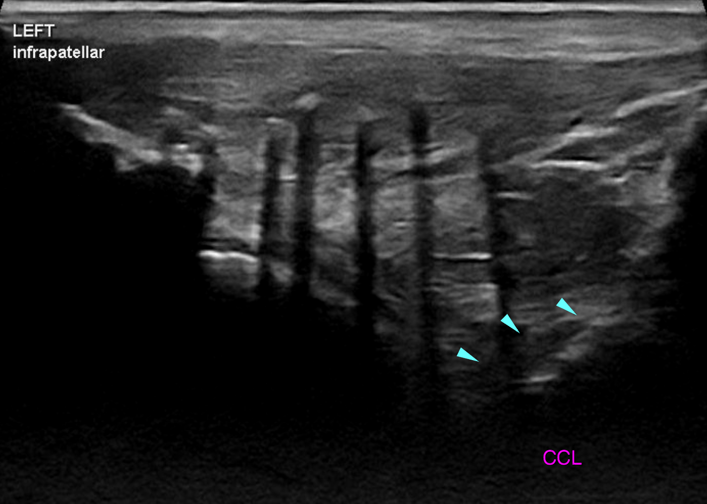 ORTHO - Chronic partial avulsion rupture of the patellar ligament, pre ...