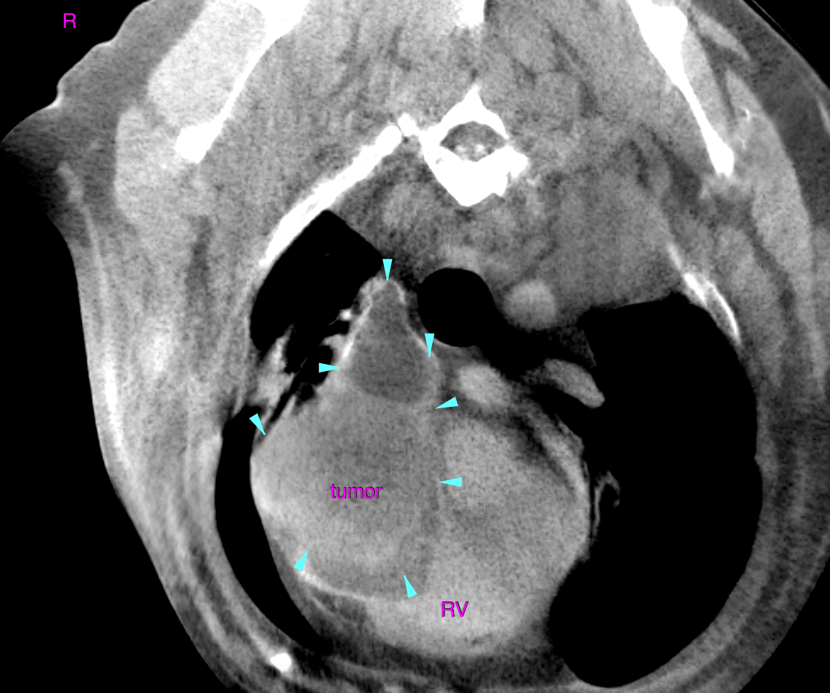 CT - Heart base tumor and intravascular expansion with CHF and ...