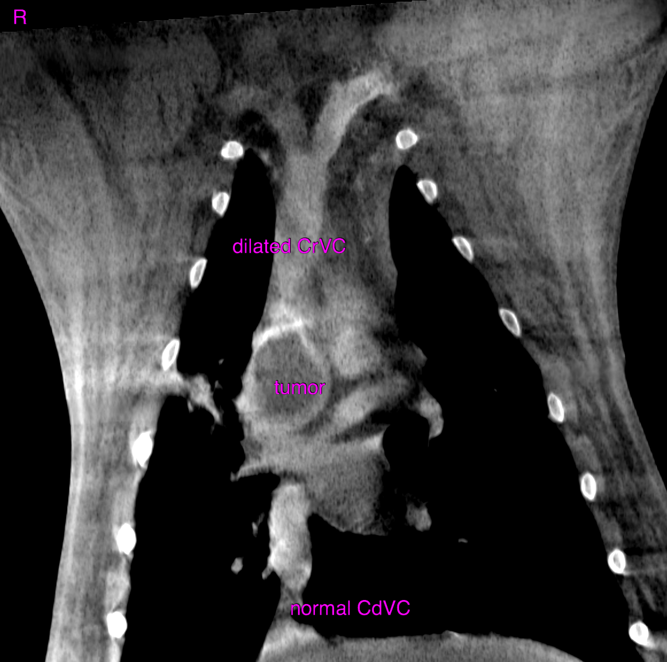 CT - Heart base tumor and intravascular expansion with CHF and ...
