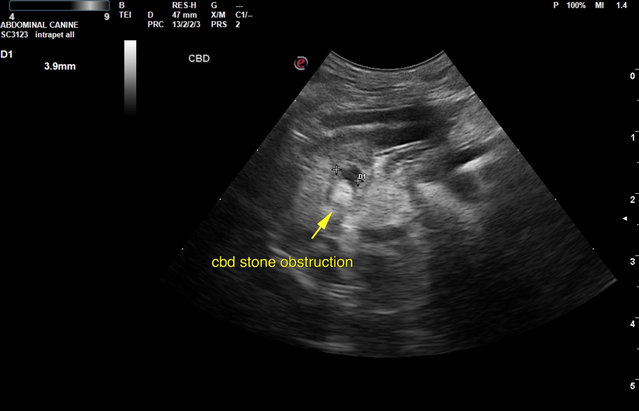 Common bile duct obstruction with chronic ductal inflammation in a 9 ...