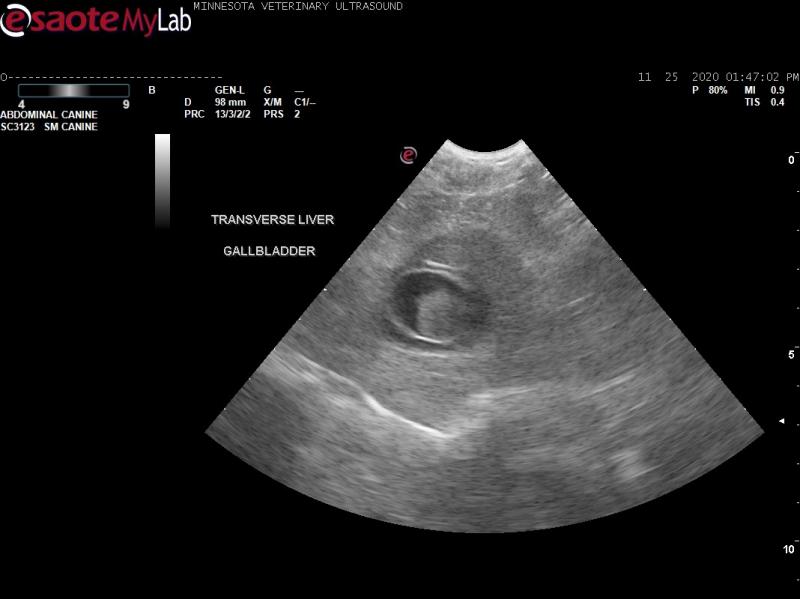 Acute depression/abd pain, GB halo sign, splenic mass, and trace ...