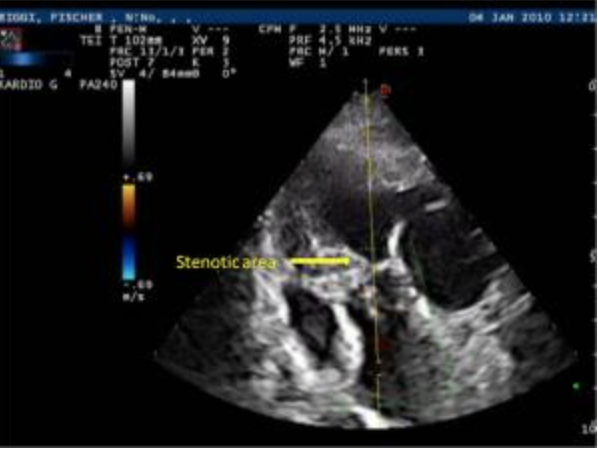 Subaortic Stenosis Case - Members